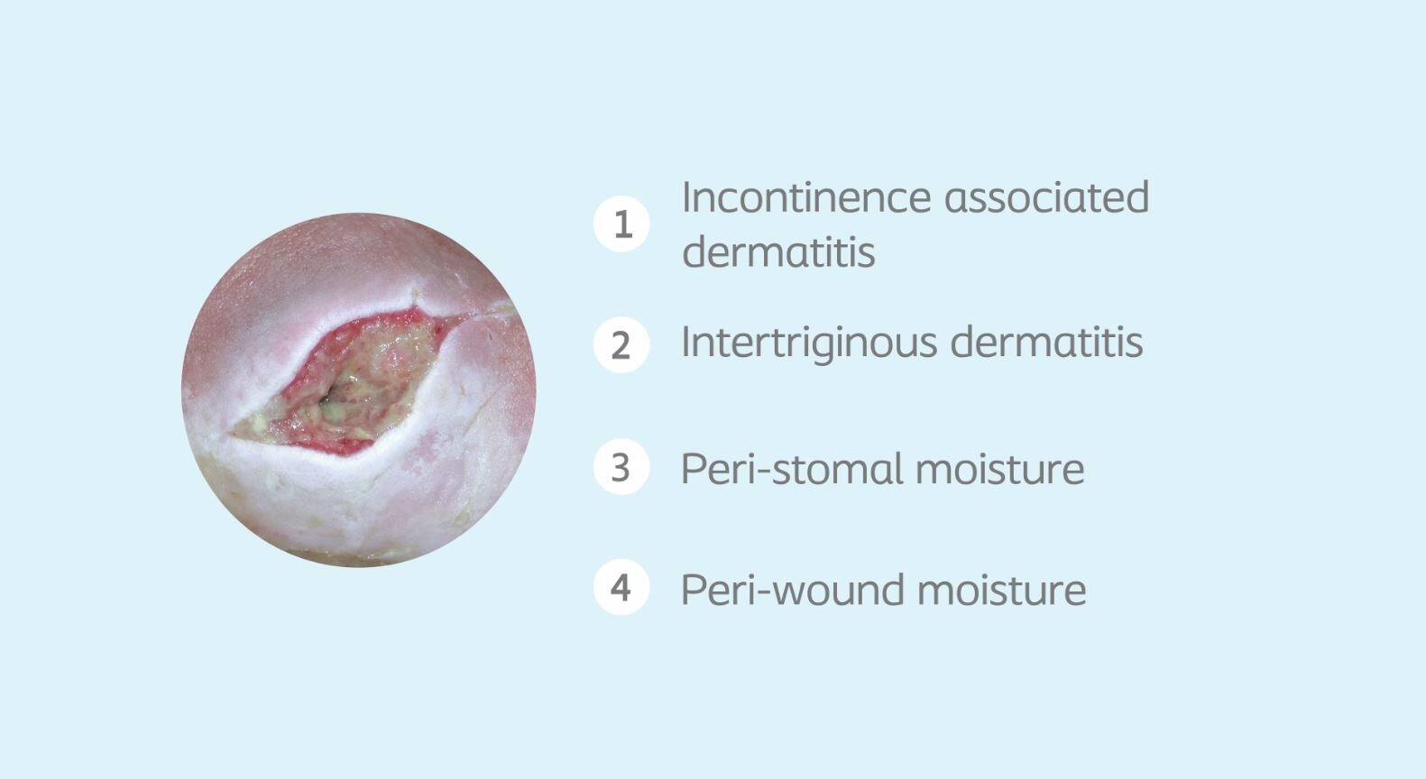 Incontinence Associated Dermatitis Ceu